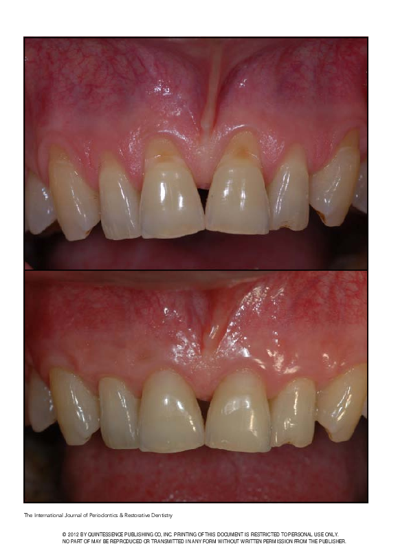 (PDF) Combined Periodontal and Restorative Approach to the Treatment of ...