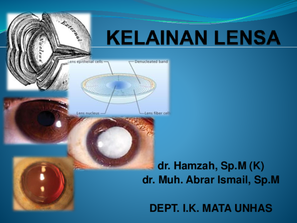 (PPT) Kelainan Lensa 2018 | muhammad arif - Academia.edu