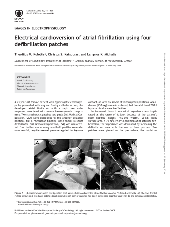 (PDF) Electrical cardioversion of atrial fibrillation using four ...