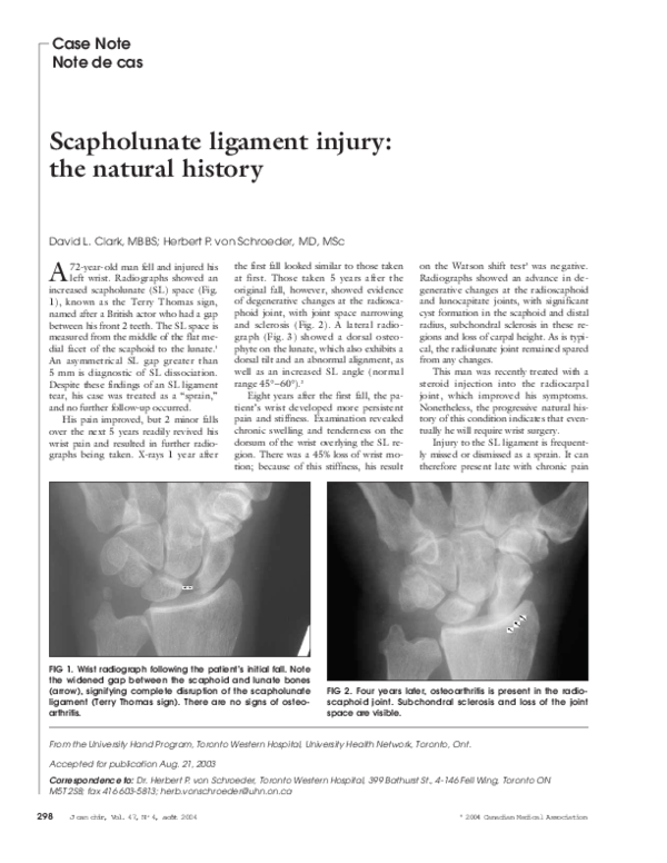 (PDF) Scapholunate ligament injury: the natural history