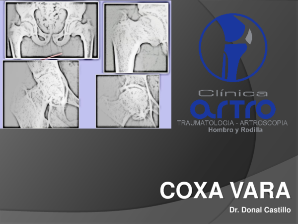(PPT) COXA VARA