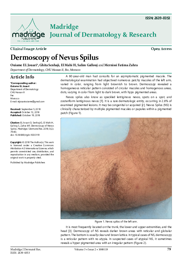 (PDF) Dermoscopy of Nevus Spilus
