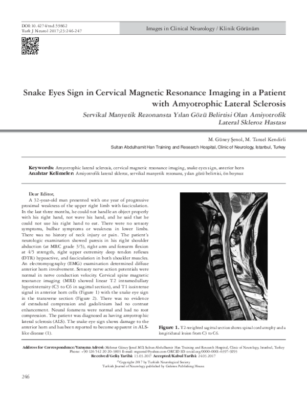 (PDF) Images in Clinical Neurology / Klinik Görünüm Snake Eyes Sign in ...