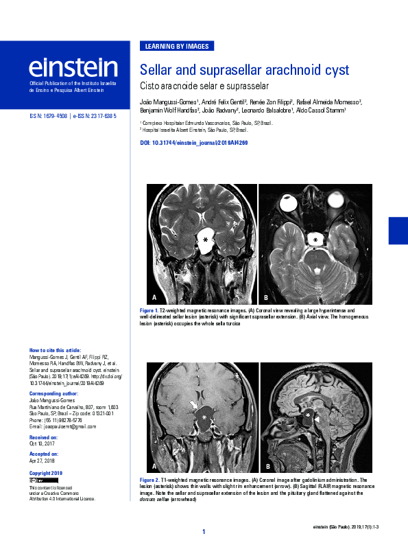 (PDF) Sellar and suprasellar arachnoid cyst