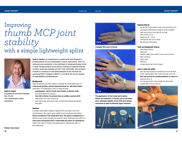(PDF) Improving thumb MCP joint stability with a simple lightweight splint