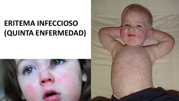 (PPT) Eritema infeccioso