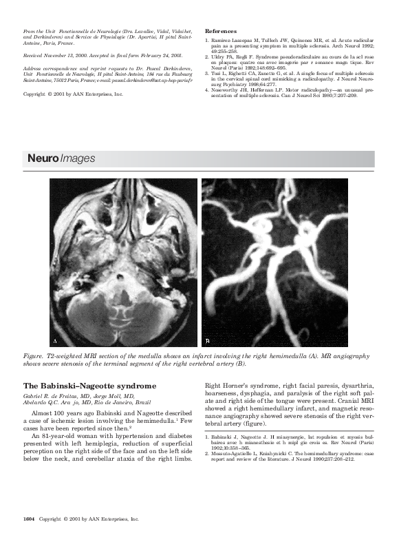 (PDF) The Babinski-Nageotte syndrome