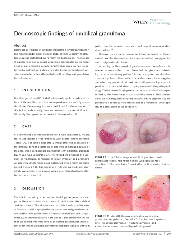 (PDF) Pediatric Dermatology Dermoscopic findings of umbilical granuloma