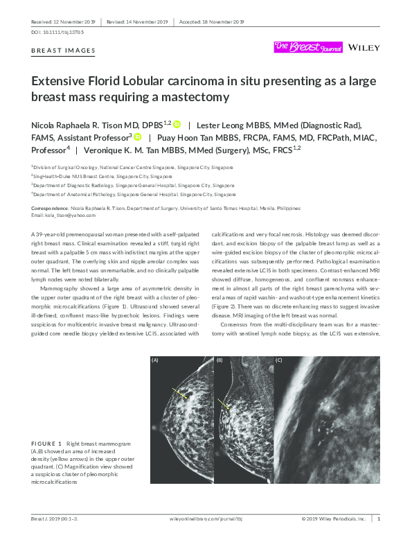 (PDF) Extensive Florid Lobular carcinoma in situ presenting as a large ...