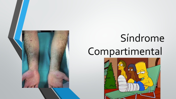 (PPT) Síndrome Compartimental