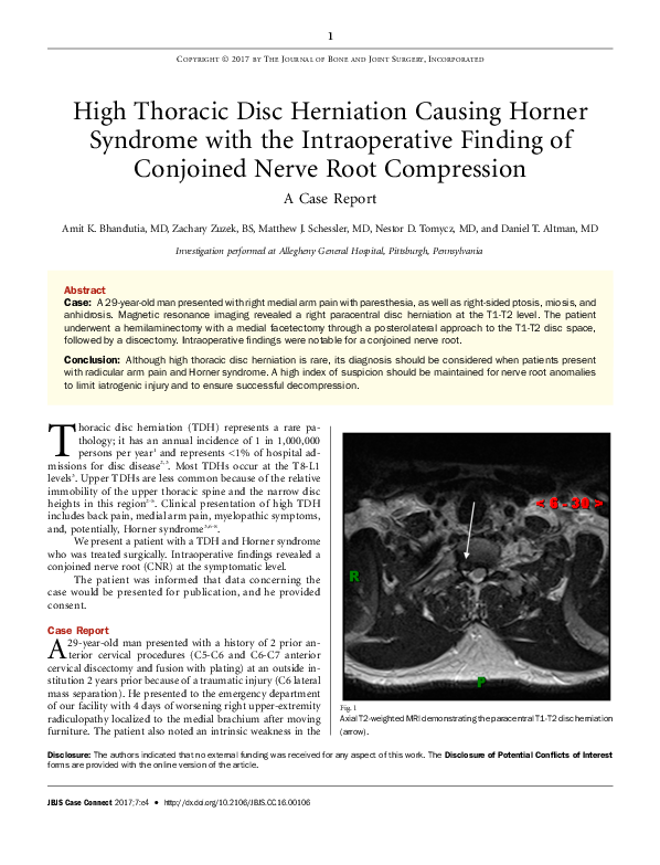 (PDF) High Thoracic Disc Herniation Causing Horner Syndrome with the ...