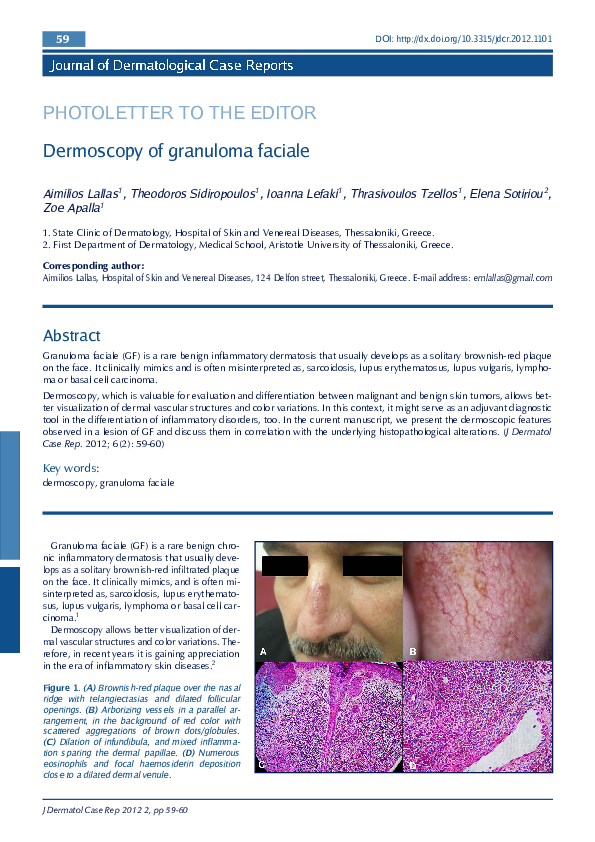 (PDF) Dermoscopy of granuloma faciale