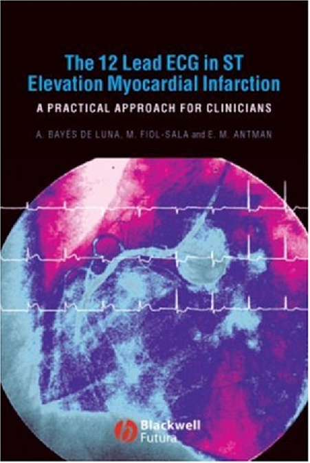 (PDF) The 12-Lead ECG in ST Elevation Myocardial Infarction A PRACTICAL ...