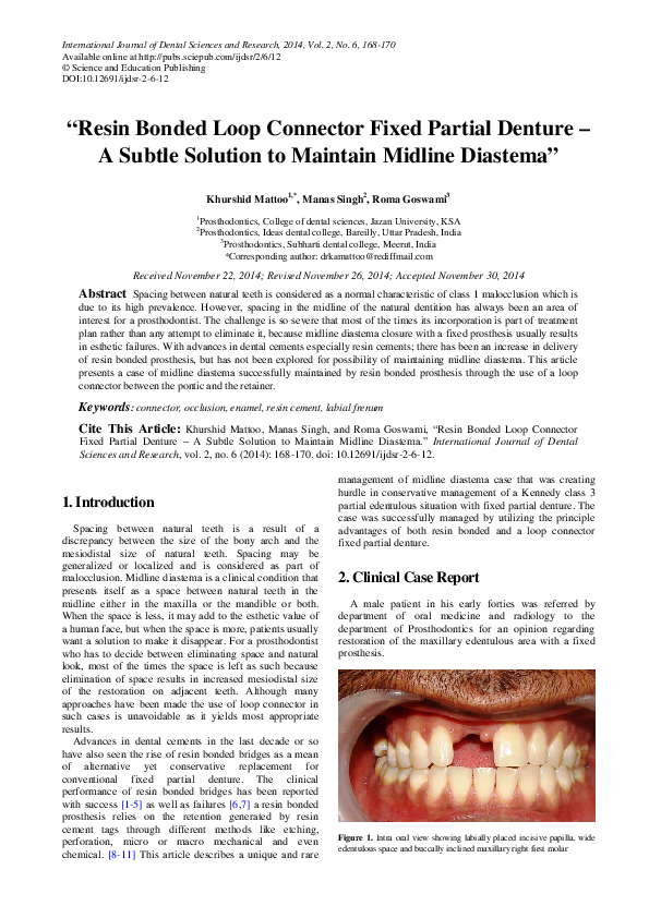 (PDF) Resin Bonded Loop Connector Fixed Partial Denture - A Subtle ...