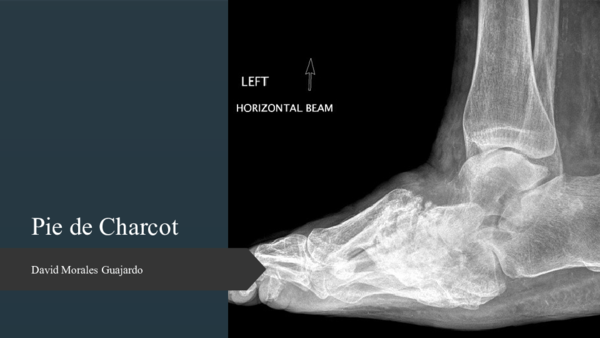 (PPT) Pie de Charcot