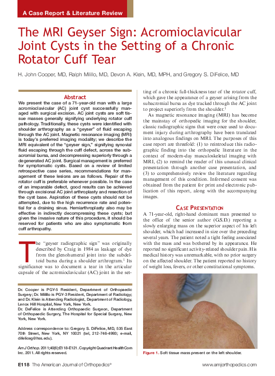 (PDF) The MRI geyser sign: acromioclavicular joint cysts in the setting ...