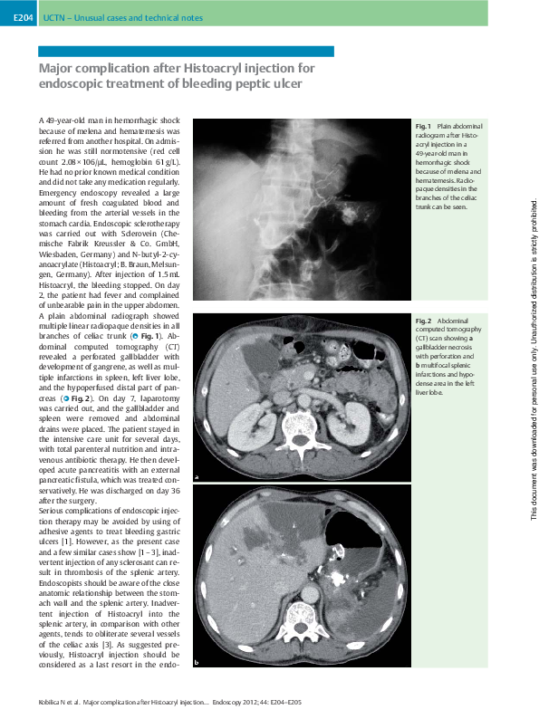 (PDF) Major complication after Histoacryl injection for endoscopic ...