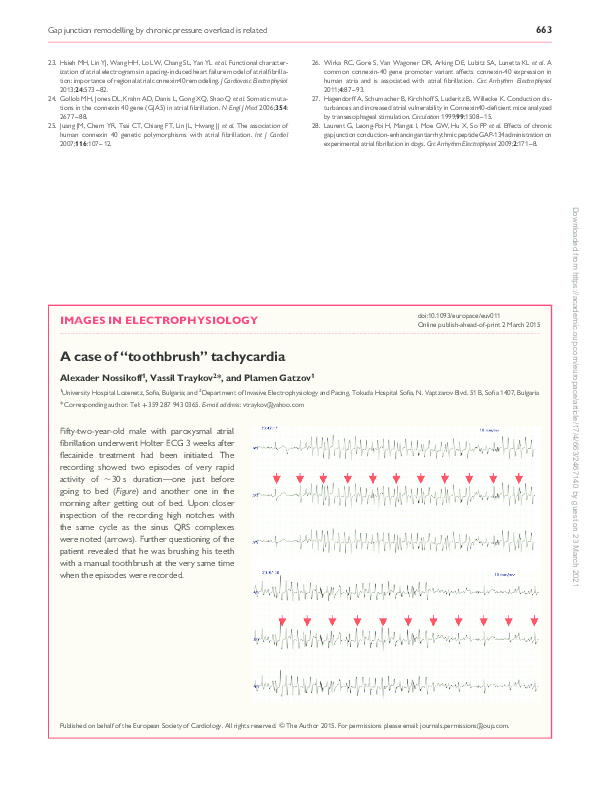 (PDF) A case of "toothbrush" tachycardia