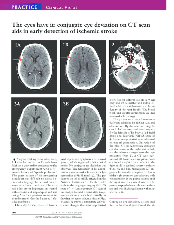 (PDF) The eyes have it: conjugate eye deviation on CT scan aids in ...