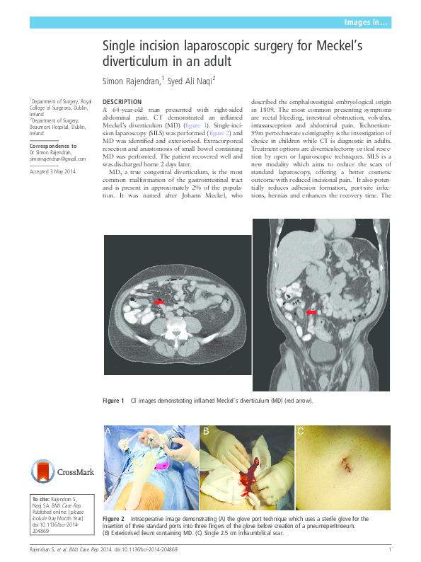 (PDF) Single incision laparoscopic surgery for Meckel's diverticulum in ...