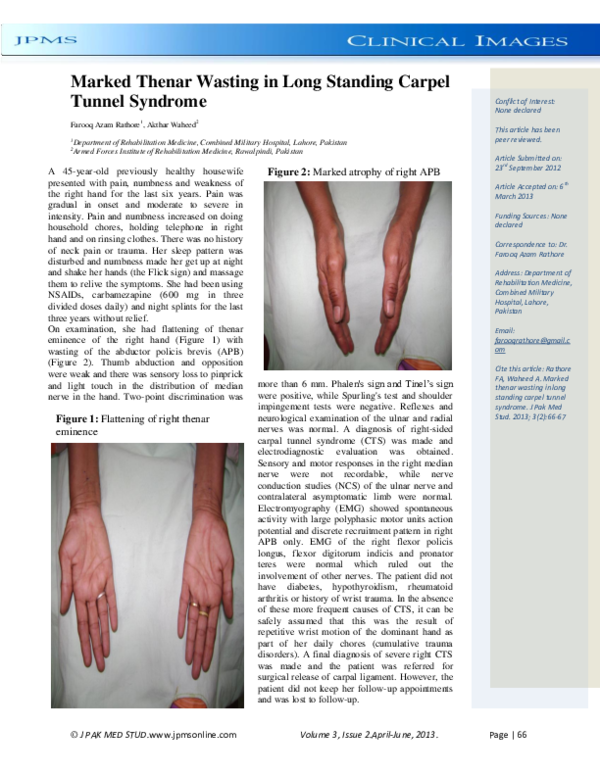 (PDF) Marked Thenar Wasting in Long Standing Carpel Tunnel Syndrome ...