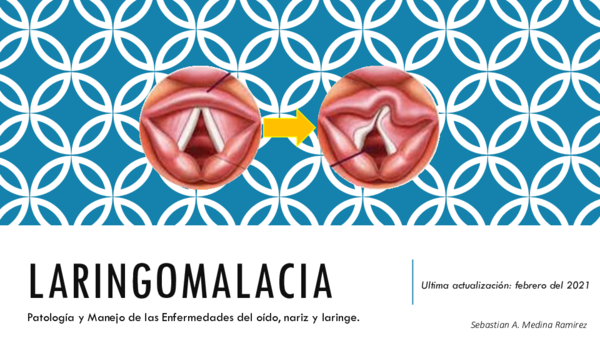 (PDF) Laringomalacia