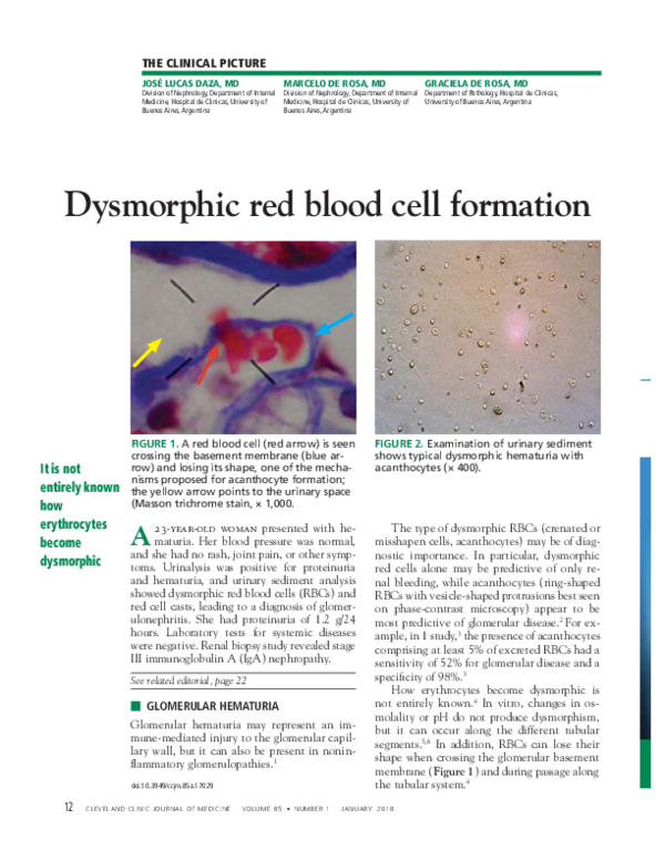 (PDF) Dysmorphic red blood cell formation