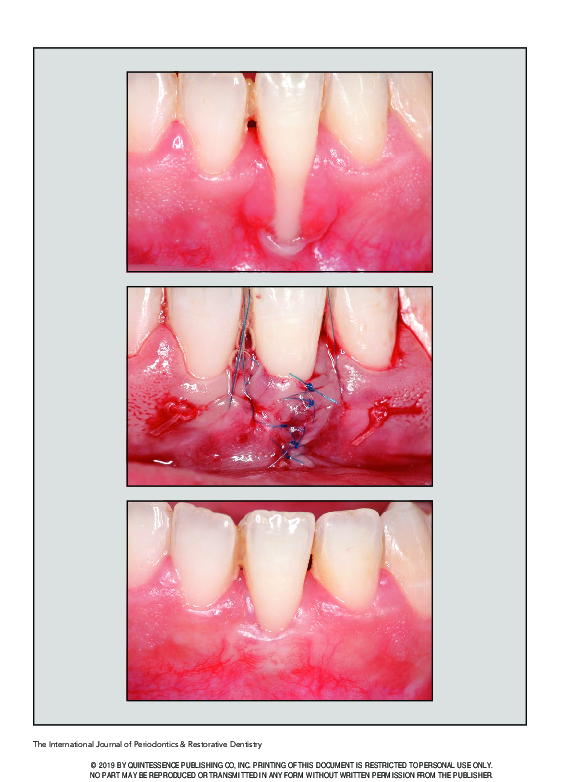 (PDF) Modified Tunnel Double Papilla Procedure for Root Coverage in the Anterior Mandible | Alon ...