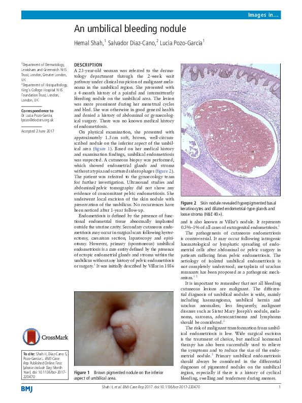 (PDF) An umbilical bleeding nodule