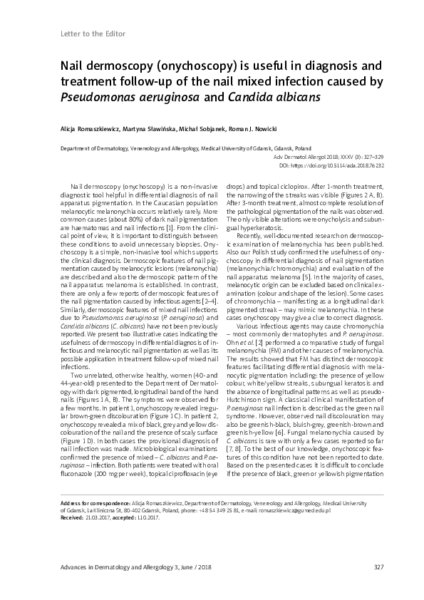(PDF) Nail dermoscopy (onychoscopy) is useful in diagnosis and ...
