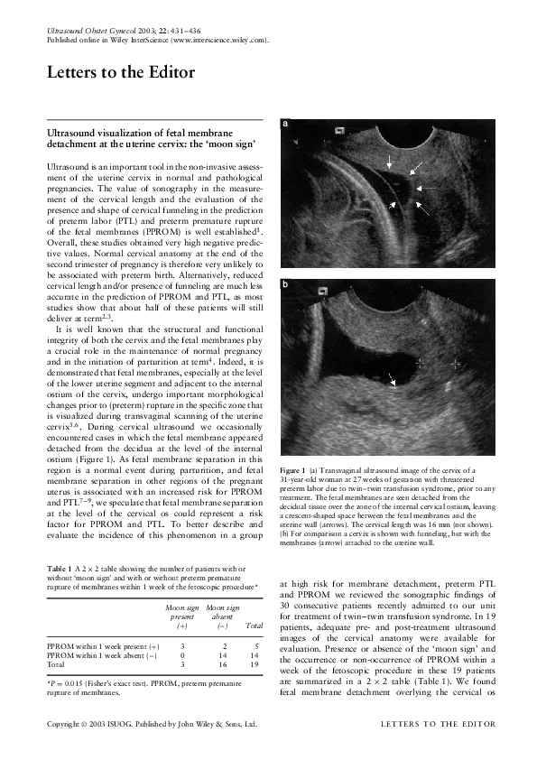 (PDF) Ultrasound visualization of fetal membrane detachment at the ...