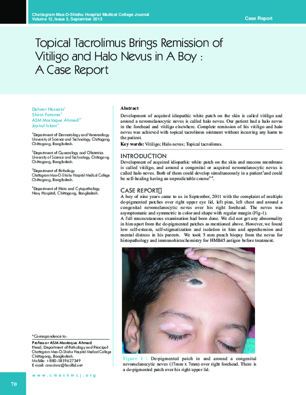 (PDF) Topical Tacrolimus Efficacy in Vitiligo and Halo Nevus Case