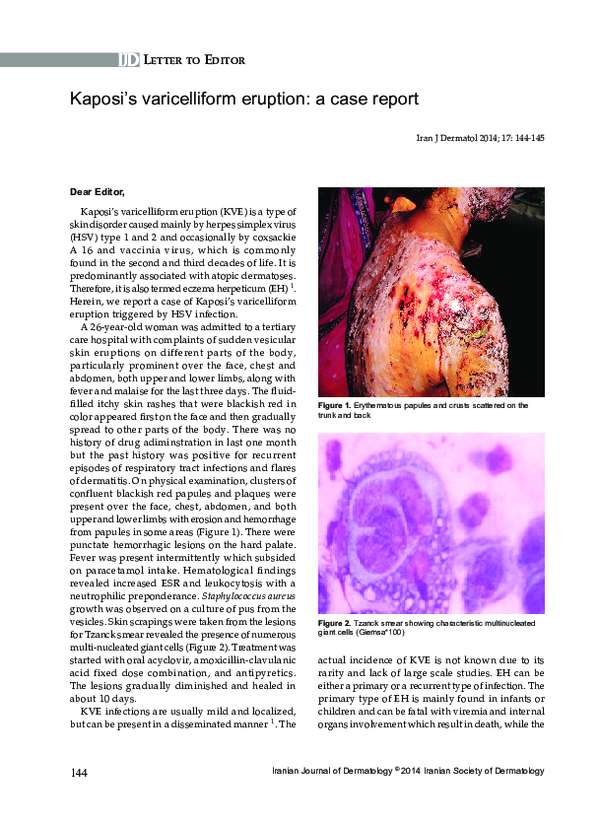 (PDF) Kaposi’s varicelliform eruption: a case report