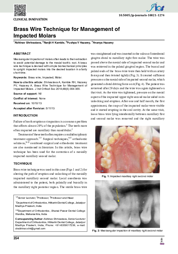 (PDF) Brass Wire Technique for Management of Impacted Molars