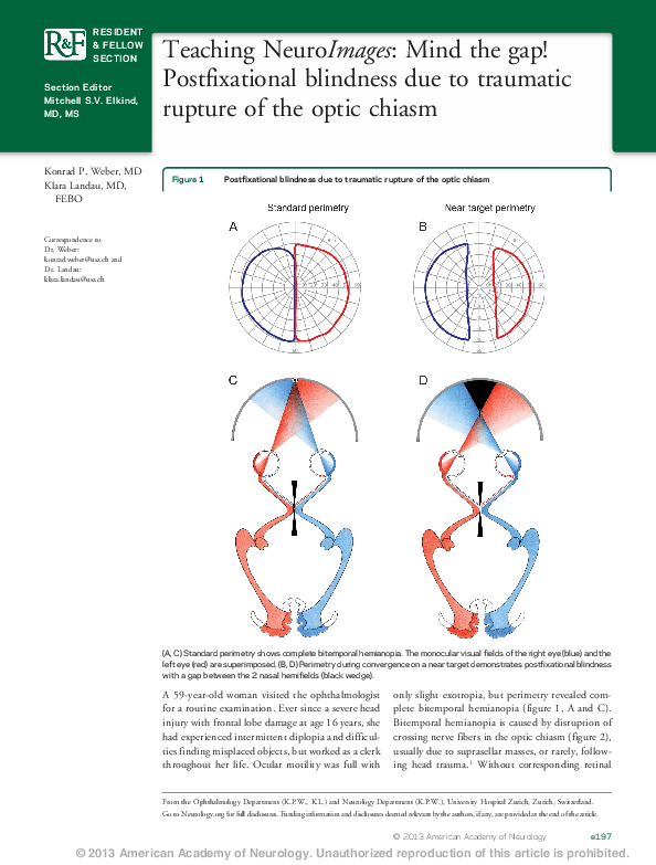 (PDF) Teaching NeuroImages: Mind the gap! Postfixational blindness due ...
