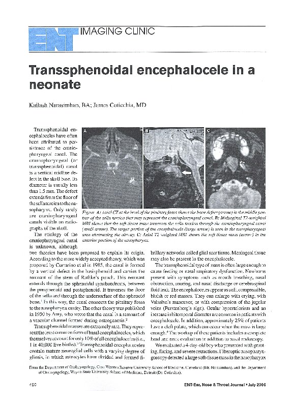 (PDF) Transsphenoidal encephalocele in a neonate