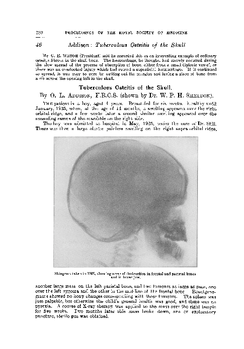 (PDF) Tuberculous osteitis of the skull