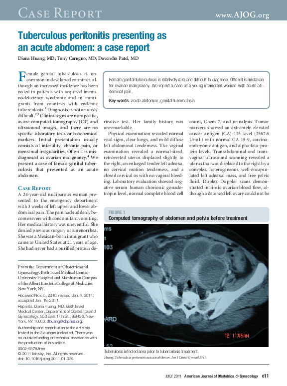 (PDF) Tuberculous peritonitis presenting as an acute abdomen: a case report