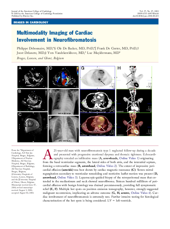 (PDF) Multimodality Imaging of Cardiac Involvement in Neurofibromatosis