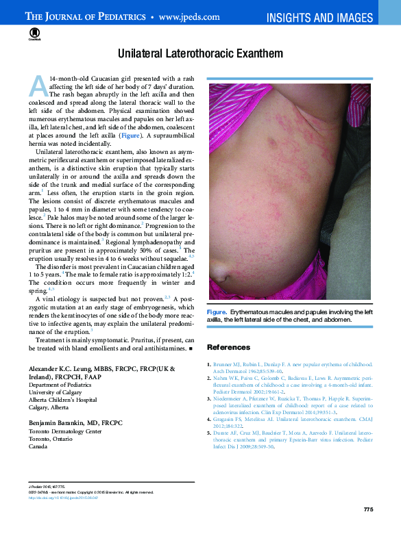 (PDF) Unilateral Laterothoracic Exanthem