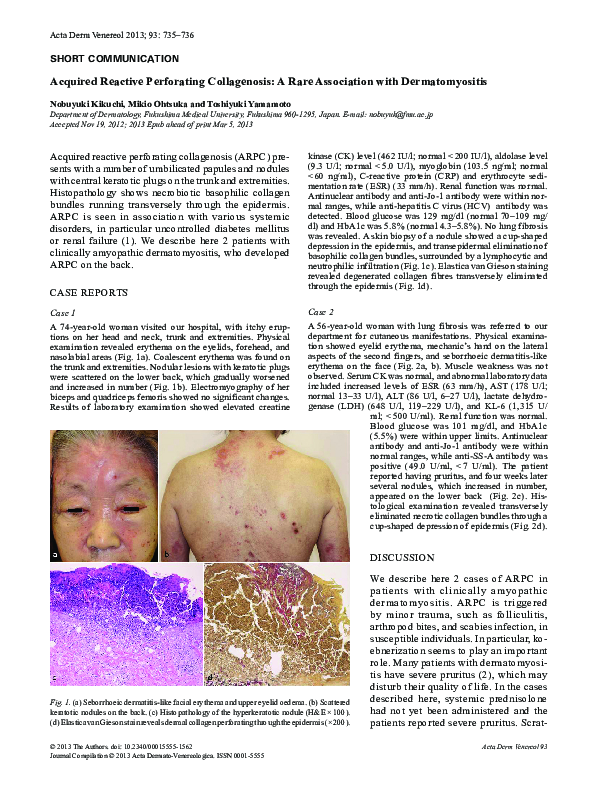 (PDF) Acquired Reactive Perforating Collagenosis: A Rare Association ...