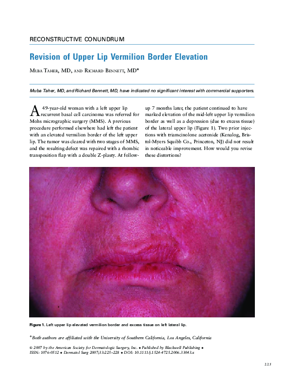 (PDF) Revision of upper lip vermilion border elevation | Muba Taher ...
