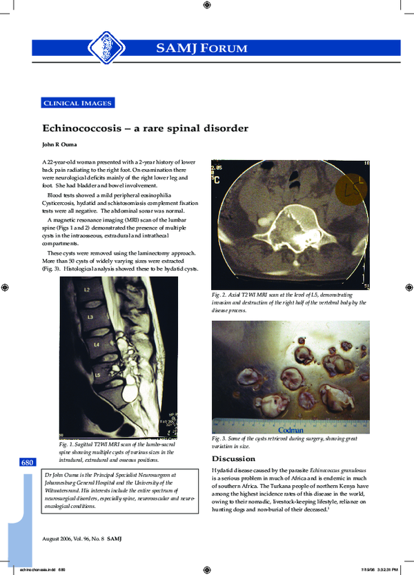 (PDF) Echinococcosis - a rare spinal disorder