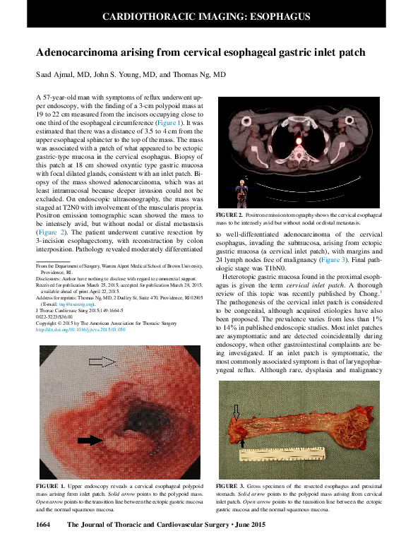 (PDF) Adenocarcinoma arising from cervical esophageal gastric inlet ...
