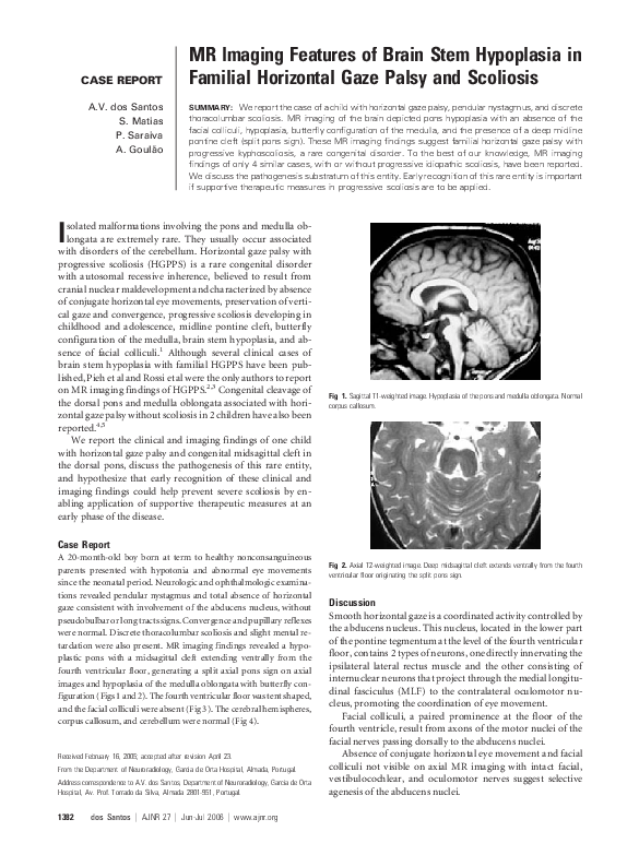 (PDF) MR imaging features of brain stem hypoplasia in familial ...