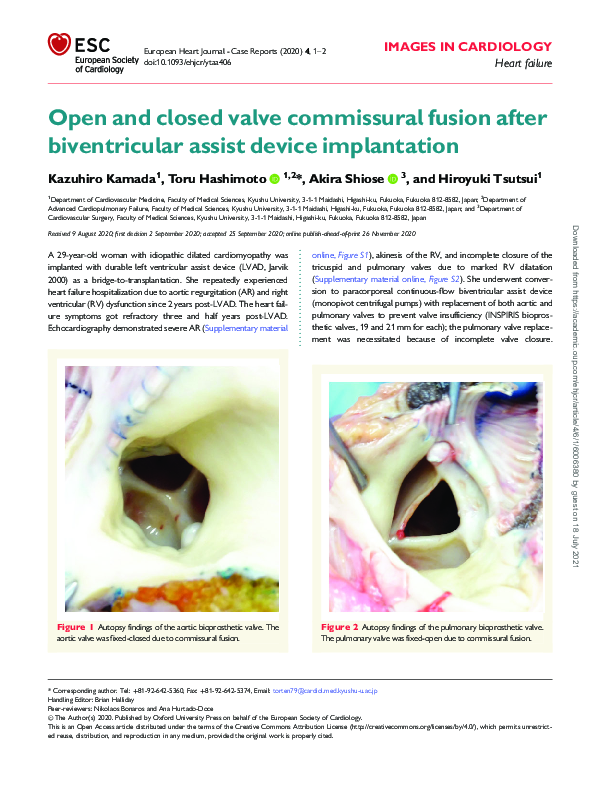 (PDF) Open and closed valve commissural fusion after biventricular ...