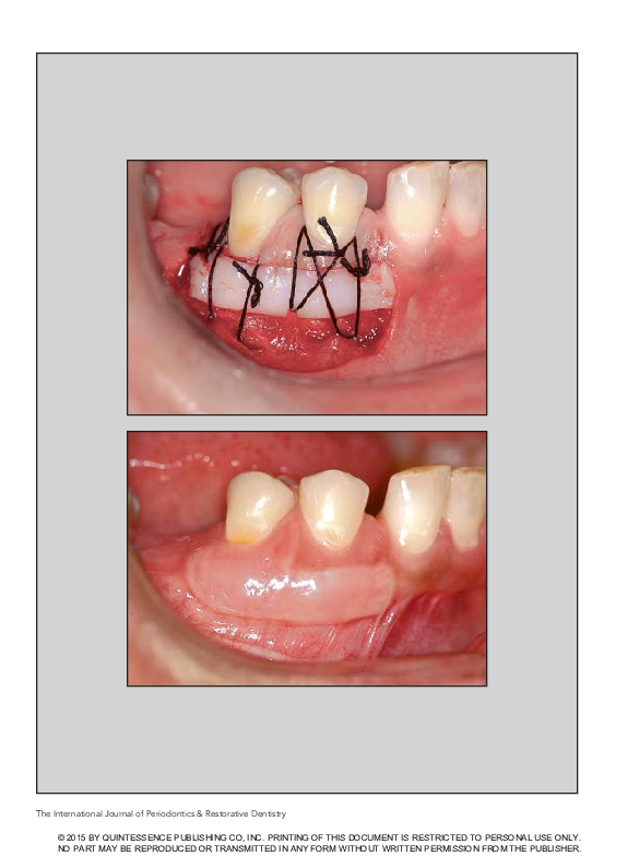 (PDF) Surgical Techniques to Increase the Apicocoronal Dimension of the ...