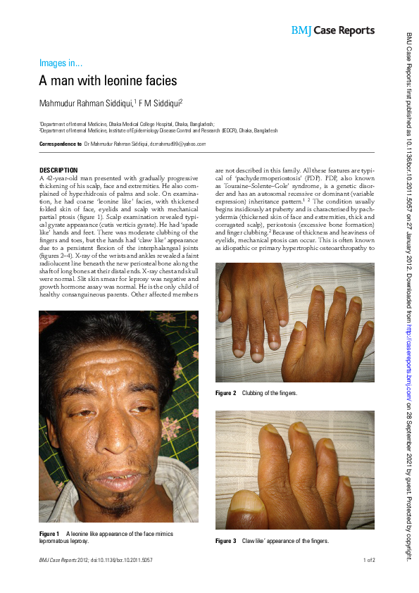 (PDF) A man with leonine facies