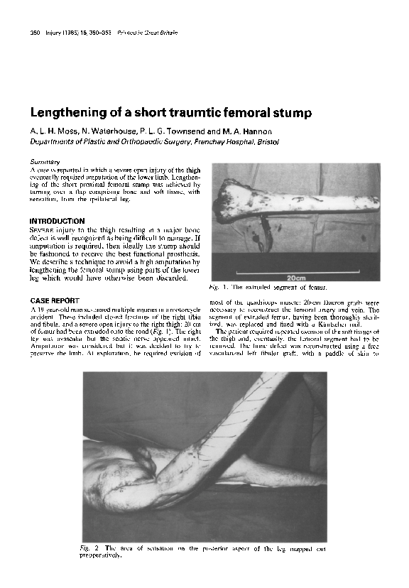 (PDF) Lengthening of a short traumtic femoral stump