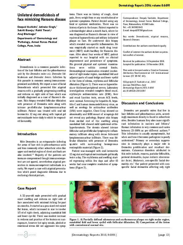 (PDF) Unilateral demodicidosis of face mimicking Hansens disease ...